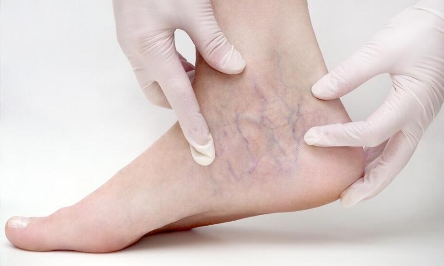 Skleroterapia - nowoczesna metoda leczenia żylaków